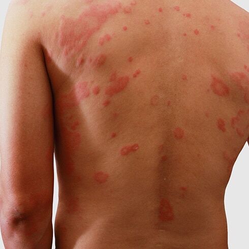 Rash Treatments El Campo TX | Victoria | Near Me